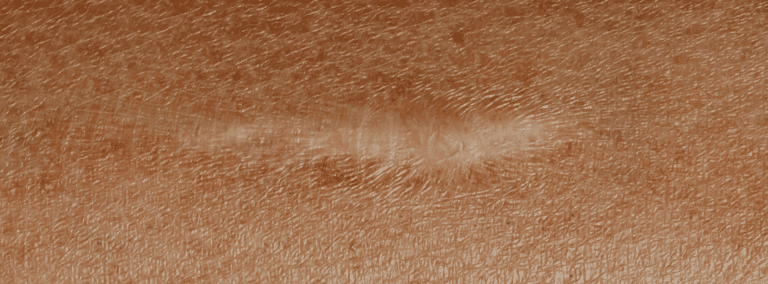 How Laser Treatment Boosts Scar Healing & Appearance